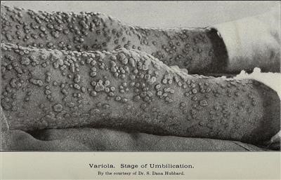 Top Compound W Plantar Wart Removal Stages Today